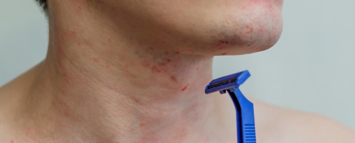 Shaving With Acne: Tips for Your Skin Care Regimen | acne.com